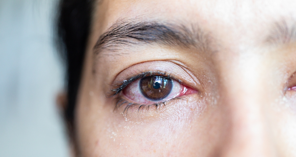 Watery Eyes: A Surprising Symptom of Dry Eye | Marion, OH | Buckeye ...